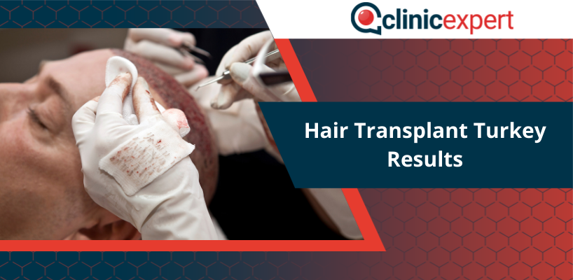 Hair Transplant Turkey Results Clinicexpert