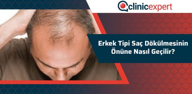 Erkek Tipi Saç Dökülmesinin Önüne Nasıl Geçilir | ClinicExpert.com Erkek Tipi Saç Dökülmesinin Önüne Nasıl Geçilir | ClinicExpert.com